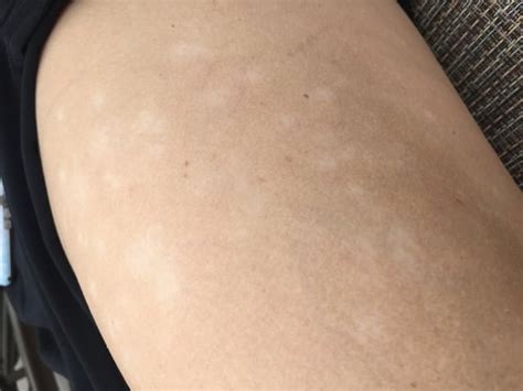White Spots On Skin