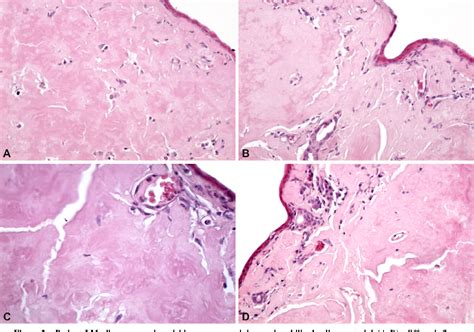 Ligneous Conjunctivitis