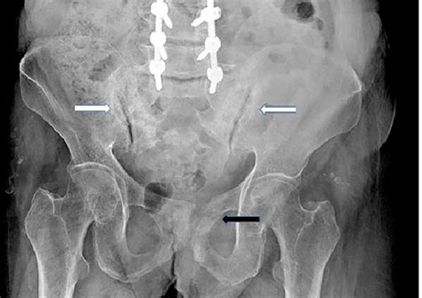 Pelvic Radiograph Demostrating Bilateral Subchondral Sclerosis In The Download Scientific