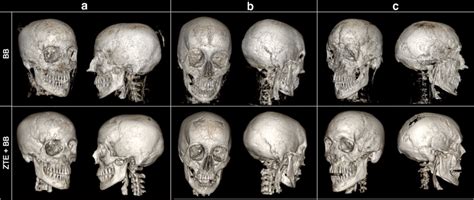 Automated 3d Reconstruction Of The Craniofacial Skeleton In Adult Download Scientific Diagram
