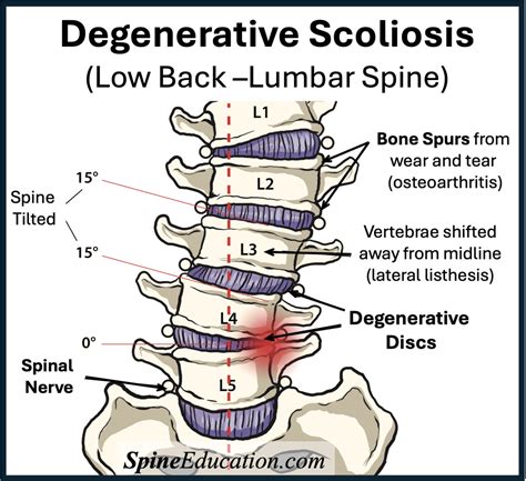 Scoliosis Spine Education