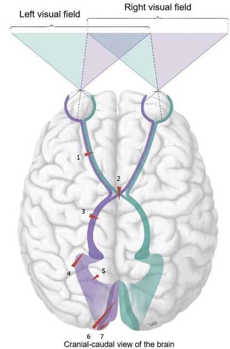 Hthsci 2f03 Primary Visual Field Defects Diagram Quizlet