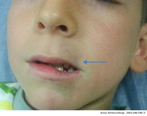 Scleroderma Lips Photos