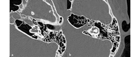 Incomplete Partition Type Iii Temporal Bone Axial Ct Scan Of A