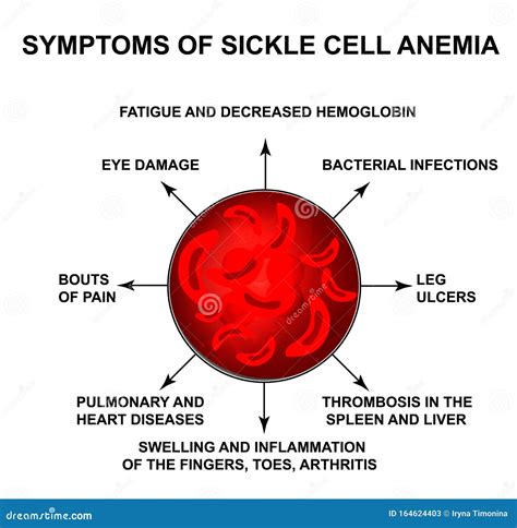 Síntomas De Anemia Falciforme Día Mundial De La Anemia Falciforme 19 De Junio Glóbulos Rojos