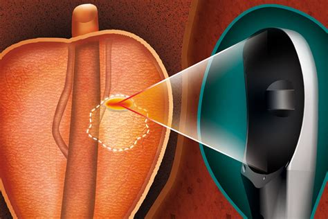 High Intensity Focused Ultrasound Hifu Conditions And Treatments