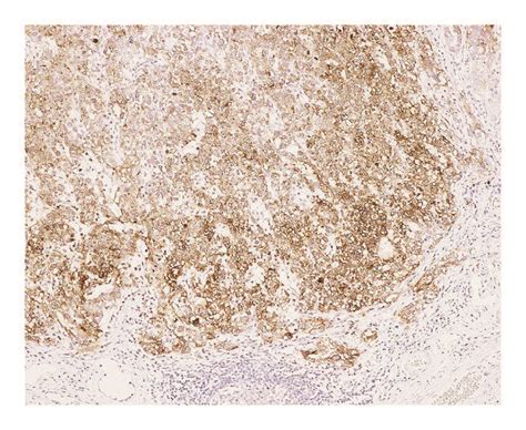 Immunohistochemical Findings The Tumor Cells Were Positive For The Download Scientific Diagram