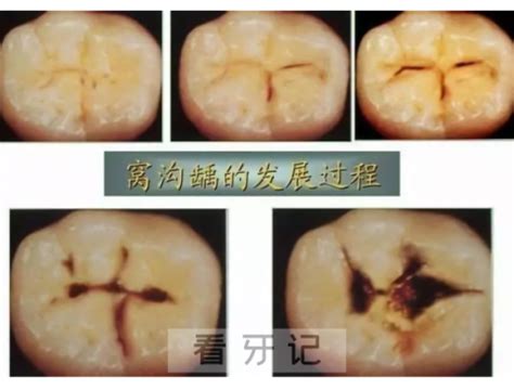 大牙上有黑线是蛀牙吗 看牙记网