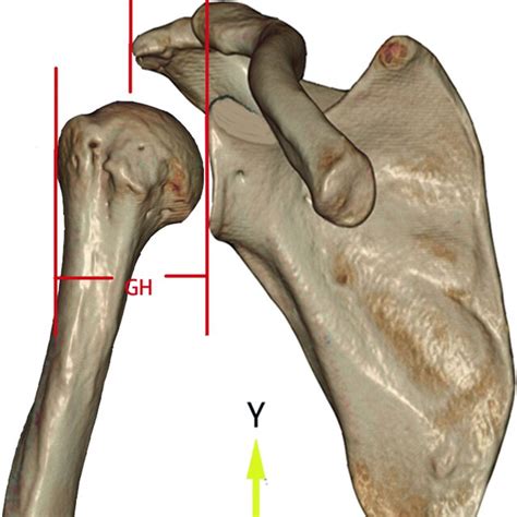 Measuring The Greater Tuberosity Angle Gta In Anteroposterior View
