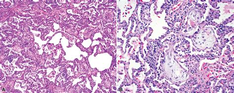 Chronic Diffuse Lung Diseases Clinical Tree