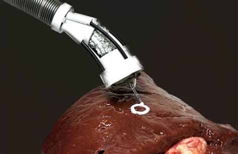 This Surgical Robotic Arm Could 3d Bioprint Inside The Human Body