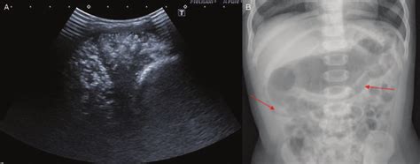 A Ultrasound At Presentation Showing Extensive Pneumobilia And B