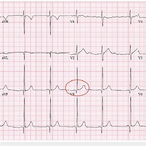 Electrocardiogram Of Patient 1 Diffuse St Elevations Circled With An
