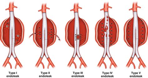 Endoleak Tuttointerventistica