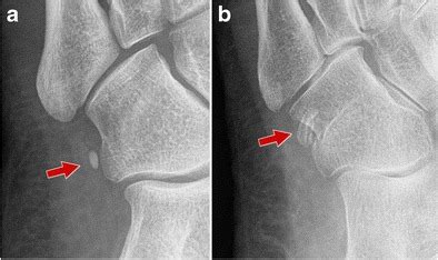 Os Peroneum Imaging Normal Appearance And Pathological Findings Pmc