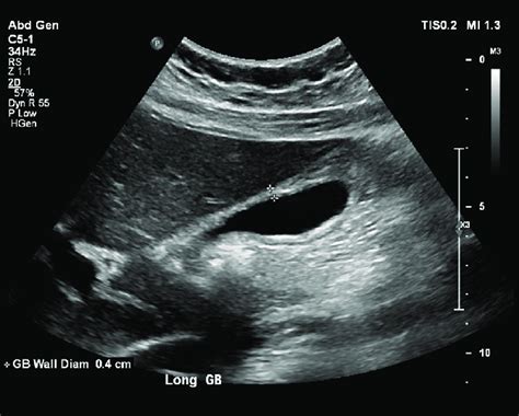 Single Image From A Right Upper Quadrant Ultrasound Centered On The