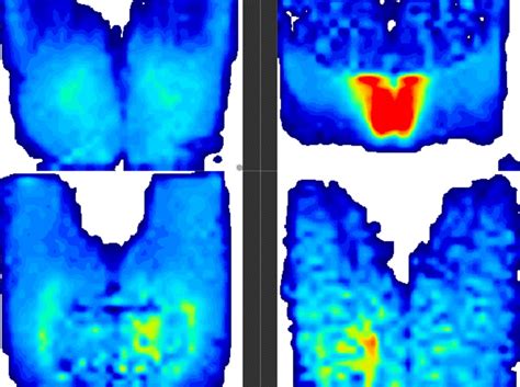 Webinar Part 4 Wheelchair Back Support Pressure Mapping