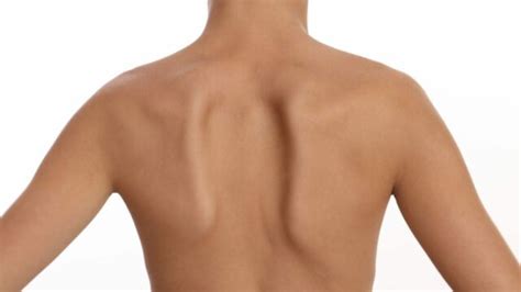 Scapular Dyskinesis Diagnosis And Treatment For Physios