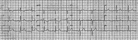 Syncope While Driving Activate The Cath Lab Dr Smiths Ecg Blog