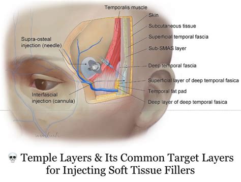 Yousef Nazari On Linkedin 💀 Temporal Fossa Augmentation 🔻injection Techniques 1 Interfascial