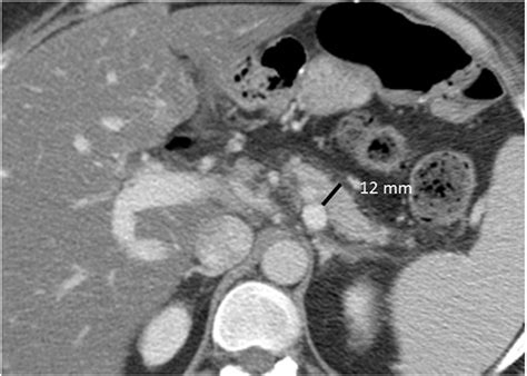 Figure 1 From Computed Tomography Based Scoring System In A Prospectively Ascertained Cohort Of