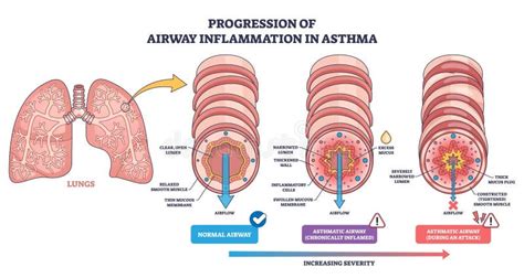 Airway Inflammation Progression In Asthma Shows Normal To Attack Stages