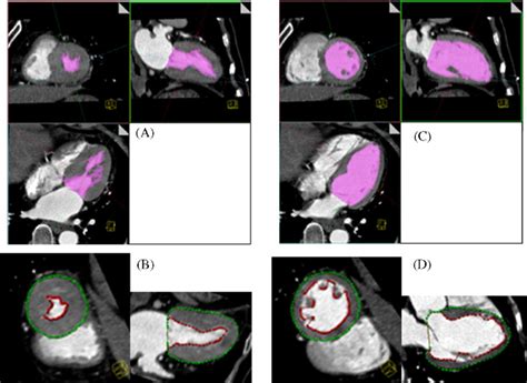 Usefulness Of Three Dimensional Automated Quantification Of Left Ventricular Mass Volume And