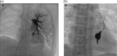A Dsa Demonstrates A 12 Mm Pseudoaneurysm Black Arrow Arising From Download Scientific