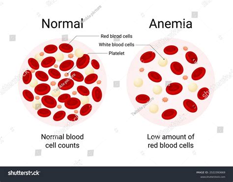 7 760 Vectores De Stock Y Arte Vectorial De Anemia Shutterstock