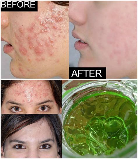 How To Make Aloe Vera Gel Benefits And Uses Of Aloe Vera My Simple