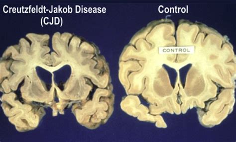 Understanding Creutzfeldt Jakob Disease