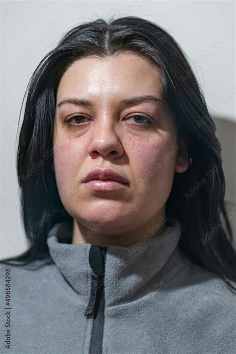 Caucasian Woman With Allergic Reaction Swelling Of Mouth Raised