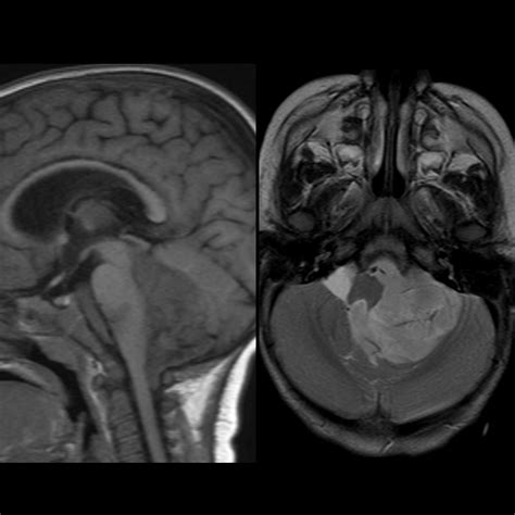 Ependymoma