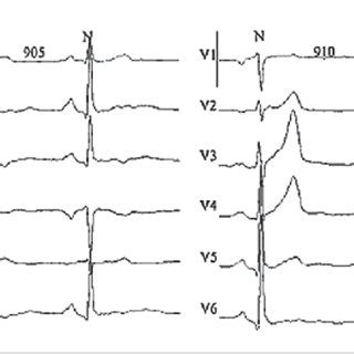 Transient Ischemic Like T Wave Inversion On The Inferior Leads During Download Scientific