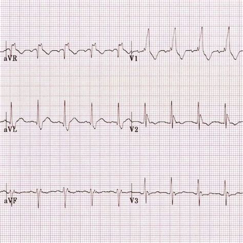 Ecg Showing Bifascicular Block Left Anterior Fascicular Block And Download Scientific Diagram
