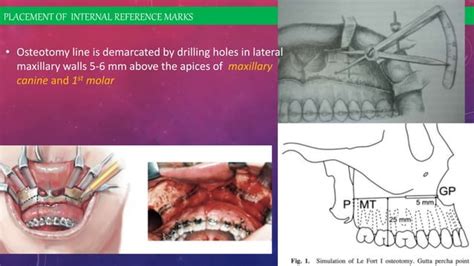 Maxillary Osteotomy Pptx