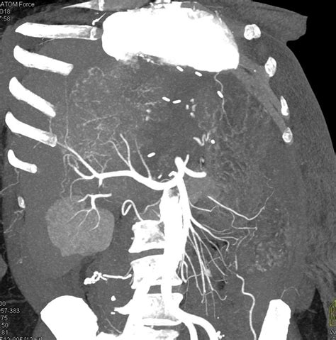 Cholangiocarcinoma Liver Case Studies Ctisus Ct Scanning