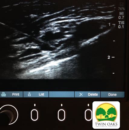 Cervical Plexus Block TWIN OAKS ANESTHESIA COURSES