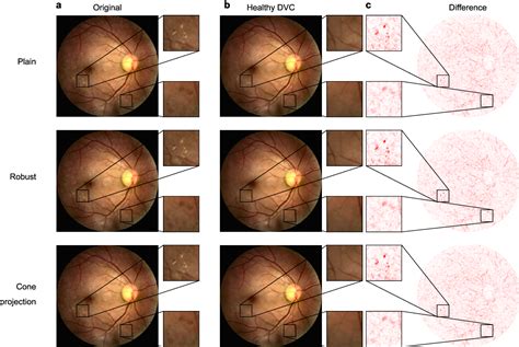 Figure 2 From Generating Realistic Counterfactuals For Retinal Fundus And Oct Images Using