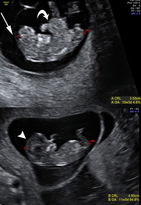 Dichorionic Diamnionic Twin Pregnancy Discordant For Anencephaly Report Of Two Cases And