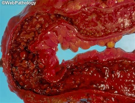 Ulcerative Colitis Gross Pathology