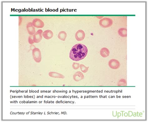 24 Megaloblastic Anemias Flashcards Quizlet