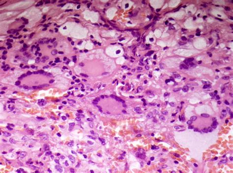 Juvenile Xanthogranuloma Related Central Diabetes Insipidus And Pregnancy Case Report And