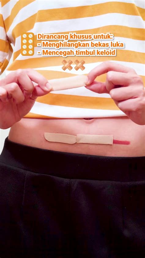 Say Bye Bye 👋 Pada Keloid Bekas Operasi Sesar Yang Bikin Nggak Pede Dengan Keloplast Dengan