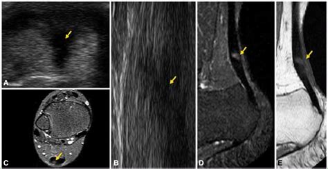 Partial Tear Of The Achilles Tendon Caused By A Glass Cut The Tendon