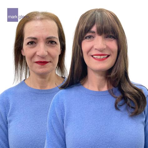 Female Hair Loss Before And After Hair Replacement Specialist Makeover