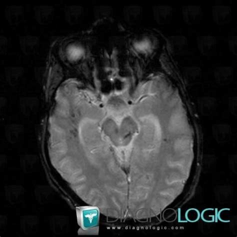 Radiology Case Diffuse Axonal Injury CT MRI Diagnologic