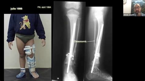 C03 Pseudoartrosis Congénita De Tibia Y Peroné Dr Miguel Galbán Youtube
