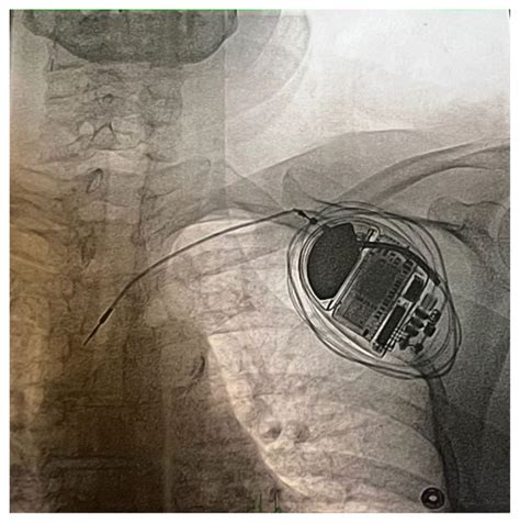 Twiddler Syndrome A Rare Complication Of Pacemaker Lead Placement Pmc