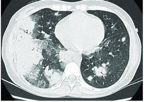 Nsip Pattern In A 70 Year Old Female With Pbc Who Died From Progressive